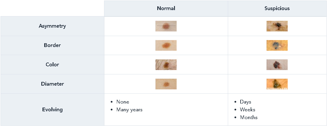 Atypical / Dysplastic Mole-test | SkinIO